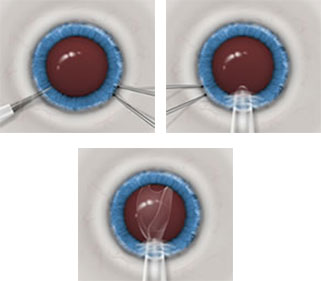 Implantable Contact Lens Pittsburgh | Visian ICL Mt. Pleasant, PA